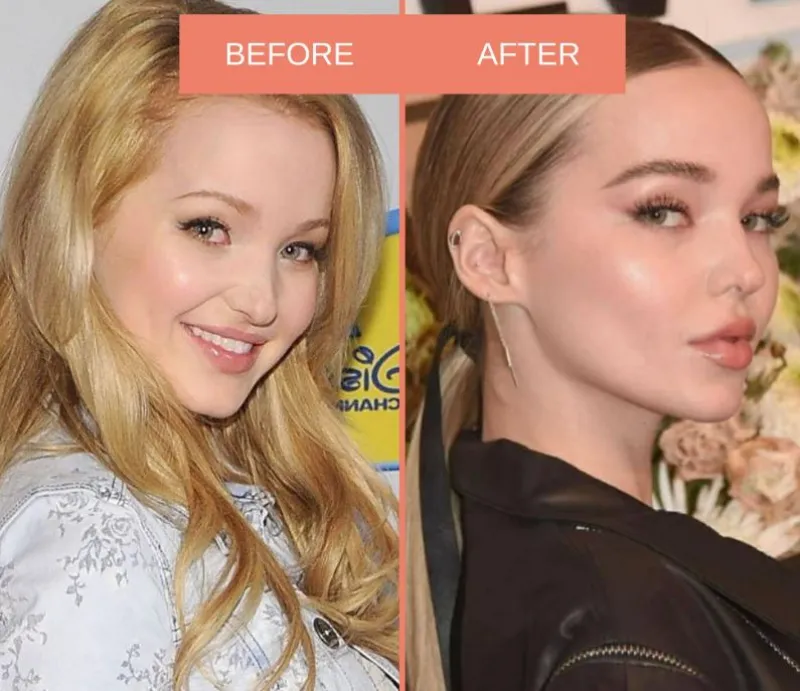 Dove Cameron prima della chirurgia estetica, un'altra persona