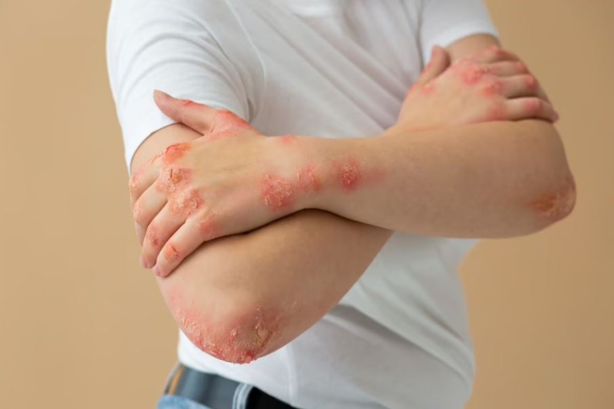 Quali sono i sintomi del Fuoco di Sant'Antonio TAG24