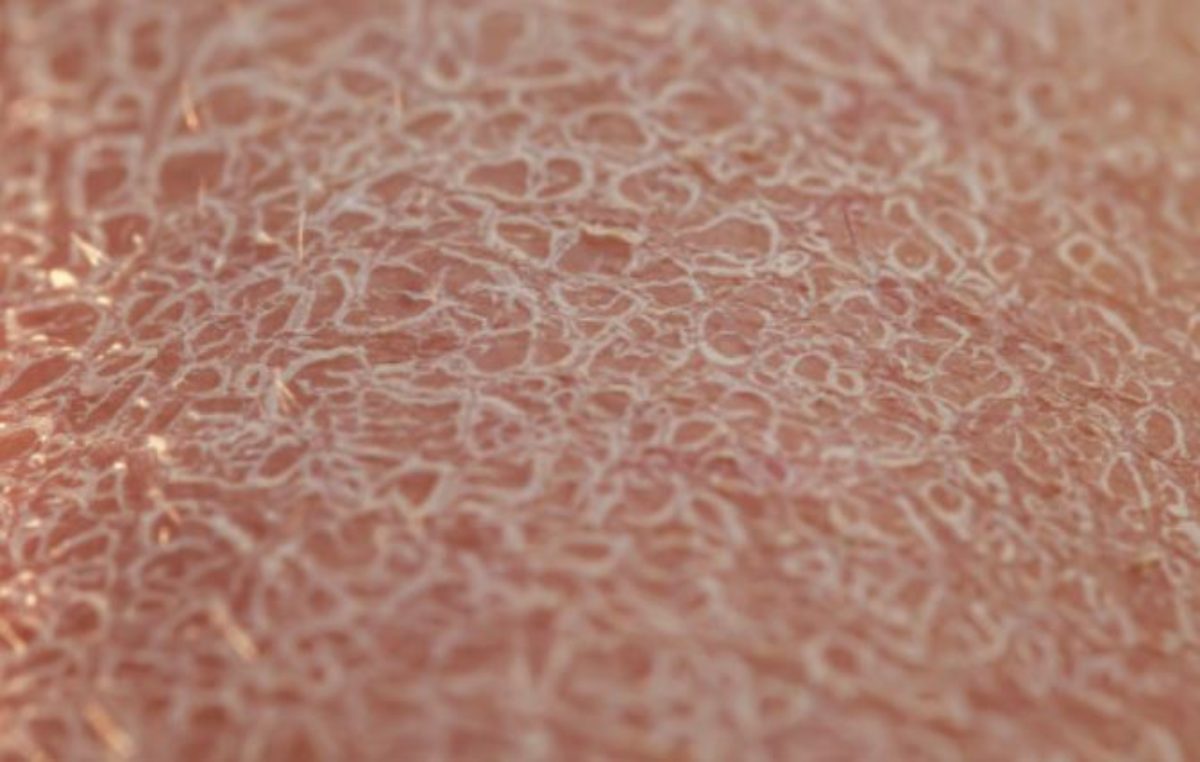 Da cosa può dipendere la desquamazione della pelle e cosa fare per ...