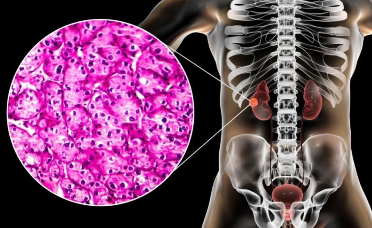 Quali sono i sintomi del tumore al rene e le nuove terapie disponibili ...